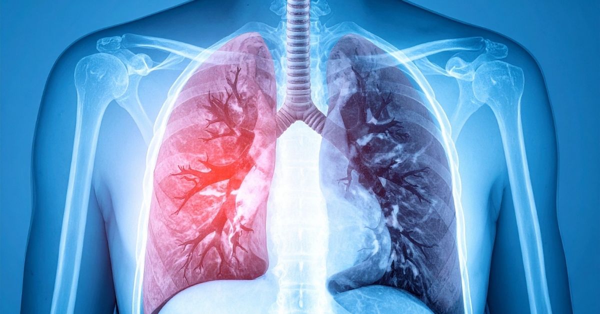 Winter & Your Lungs: Cold Weather Effects and Care Tips